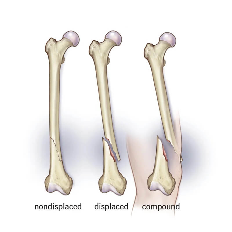 Types Of Sports Injuries II | Kofa Study