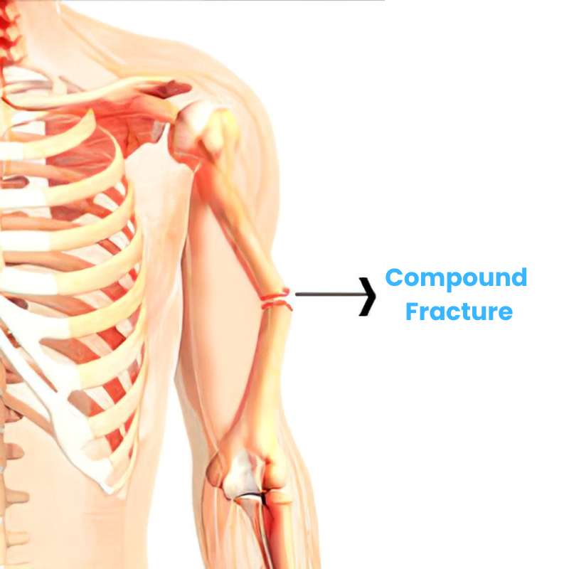 Compound Fracture Diagram